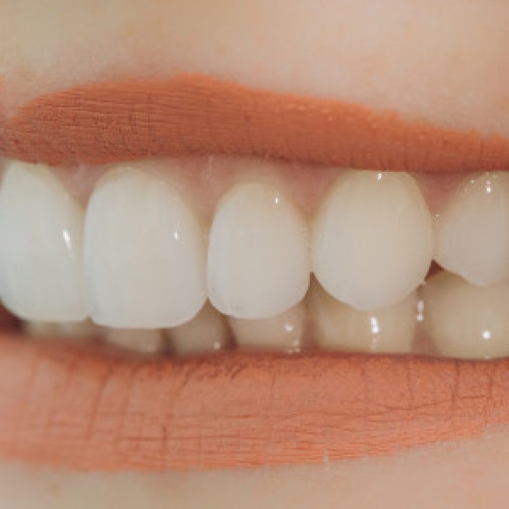 Pasos del cementado con Disilicato o Cerámica y del cementado con ...